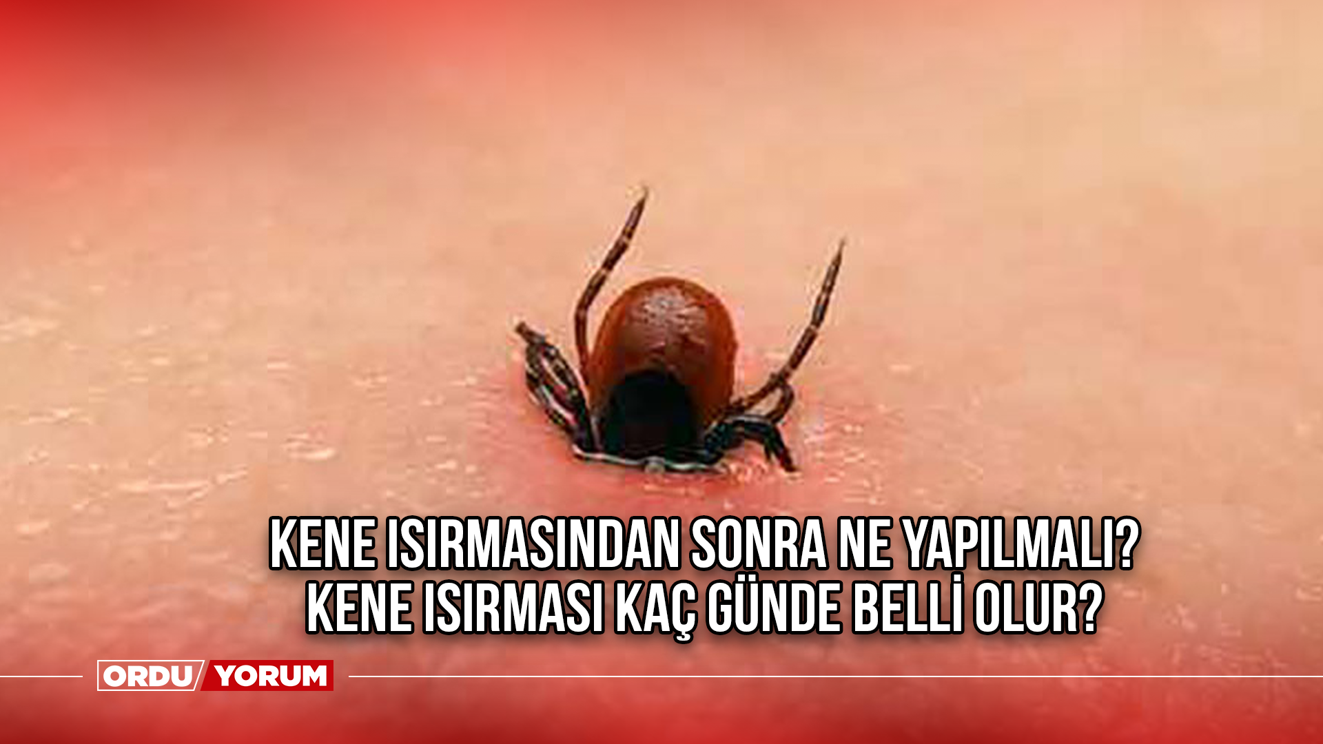 Kene ısırmasından sonra ne yapılmalı? Kene ısırması kaç günde belli olur?