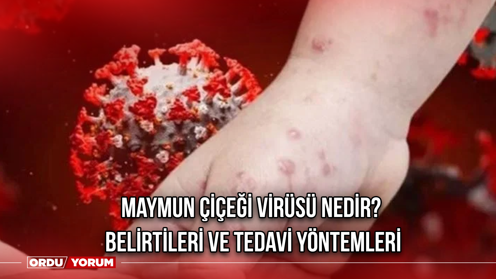 Maymun Çiçeği Virüsü Nedir? Belirtileri ve Tedavi Yöntemleri